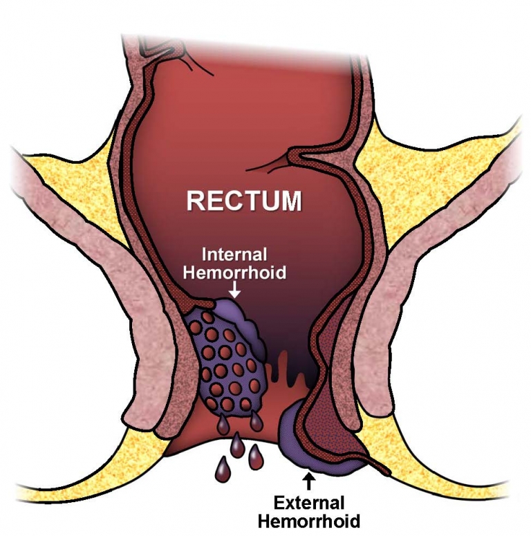 Hemorrhoids Causes Symptoms Management Dubai UAE Westminster Hemorrhoids Causes Symptoms Management Dubai UAE Westminster