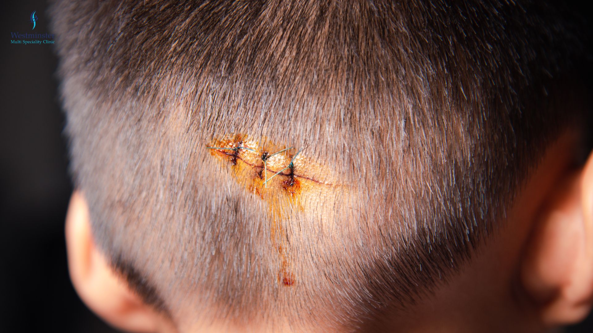 - Dubai Healthcare City | Westminster Ortho Med Clinic Suturing of ...